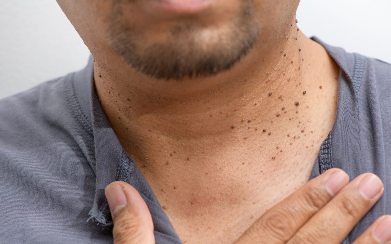 HOW TO KNOW WHEN TO GET A SKIN TAG REMOVED – Resurgence Wellness